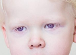 Tipos de albinismo: quais são, características e como cuidar